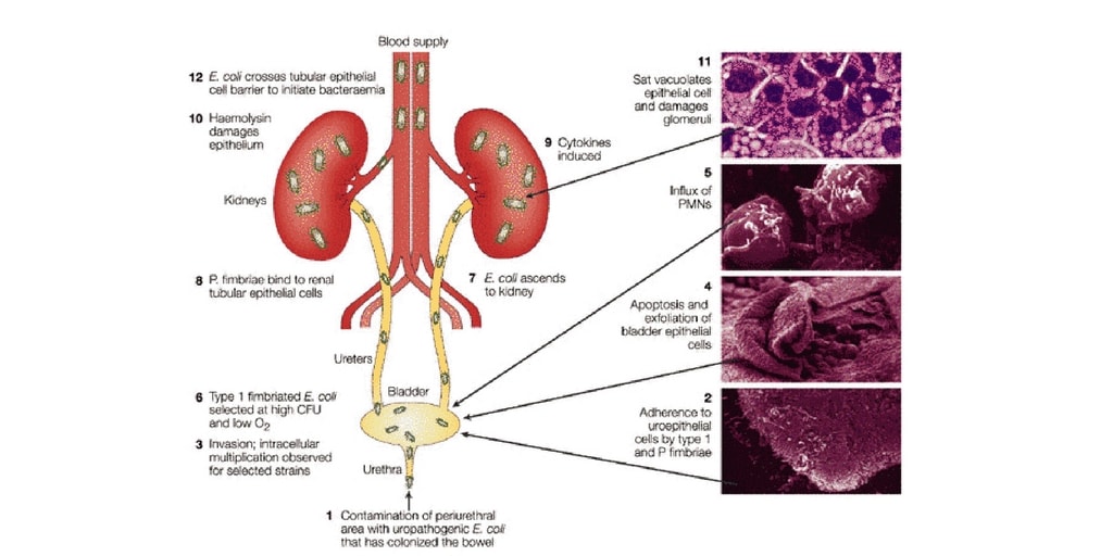 Urinary Tract Infection in Postpartum Women - RNpedia