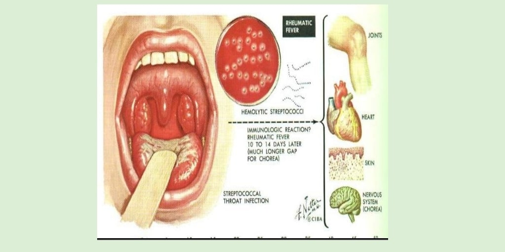 Rheumatic Fever Nursing Care Plan & Management - RNpedia Rheumatic Fever Nursing Care Plan & Management - RNpedia